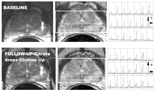 Prostate Mri Reference Guide Pi Rads Version 2